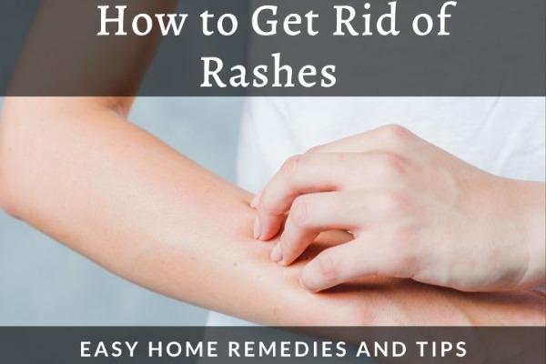 How to Get Rid of Rashes: Easy Home Remedies and Tips